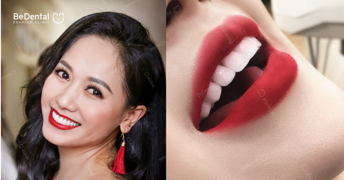 ALL YOU NEED TO KNOW ABOUT LISI PRESS PORCELAIN DENTAL CROWNS – Nha ...