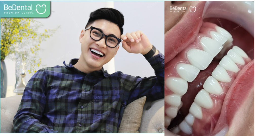 ALL YOU NEED TO KNOW ABOUT LISI PRESS PORCELAIN DENTAL CROWNS – Nha ...