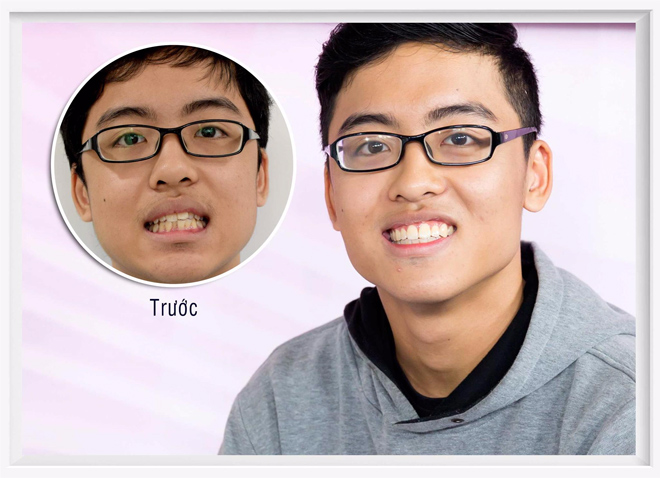 TIÊU CHUẨN ĐÁNH GIÁ MỘT HÀM RĂNG ĐẸP NAM MÀ BẠN CẦN BIẾT - Be Dental