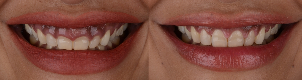 GUM CONTOURING – DOES IT HURT AND HOW MUCH DOES IT COST? – Nha Khoa ...