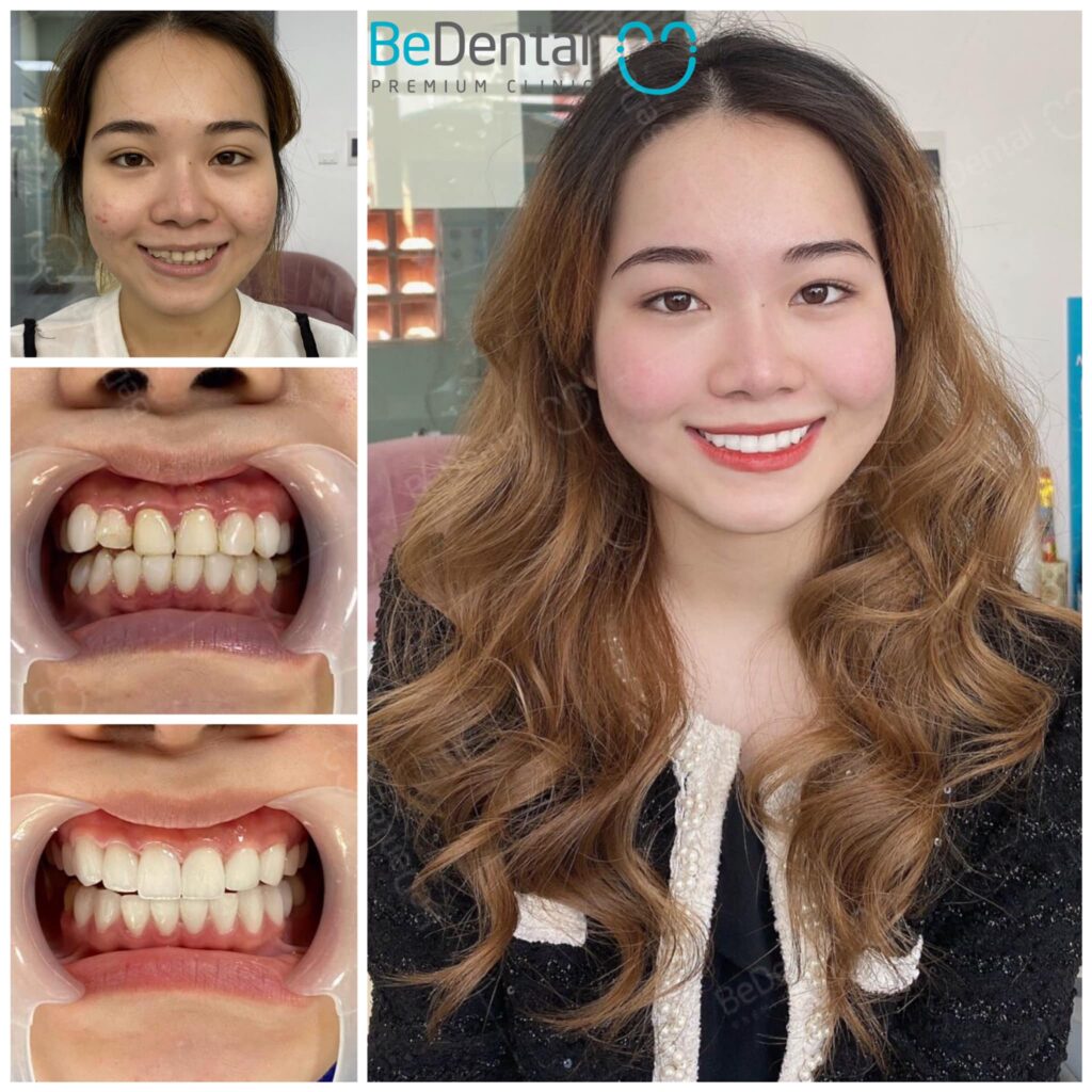 Mài răng là gì? Mài răng có đau không? Chi phí mài răng? – Be Dental