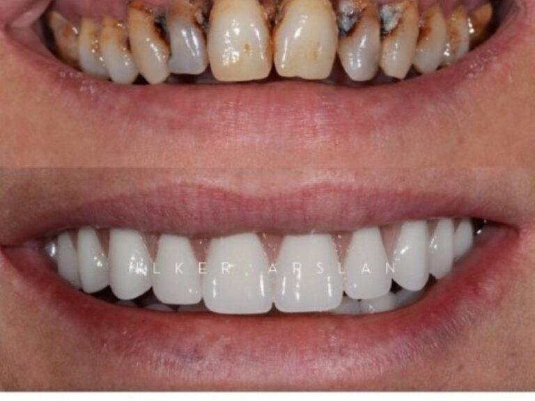 Tổng hợp 70+ hình ảnh răng đẹp, nụ cười đẹp chuẩn nha khoa – Nha Khoa ...