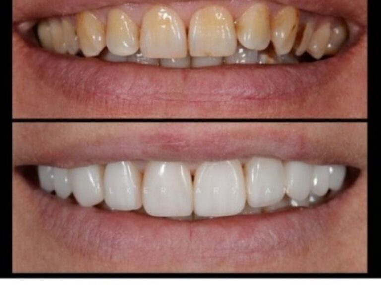 Tổng hợp 70+ hình ảnh răng đẹp, nụ cười đẹp chuẩn nha khoa – Nha Khoa ...