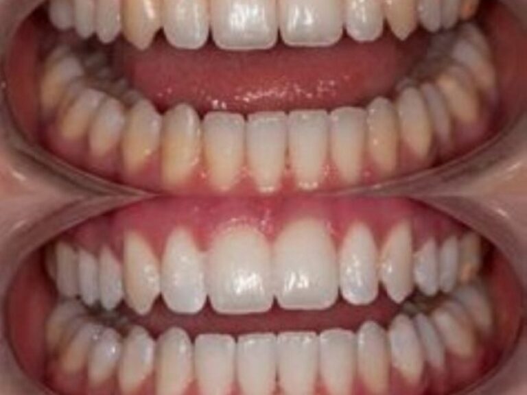 Tổng hợp 70+ hình ảnh răng đẹp, nụ cười đẹp chuẩn nha khoa – Nha Khoa ...