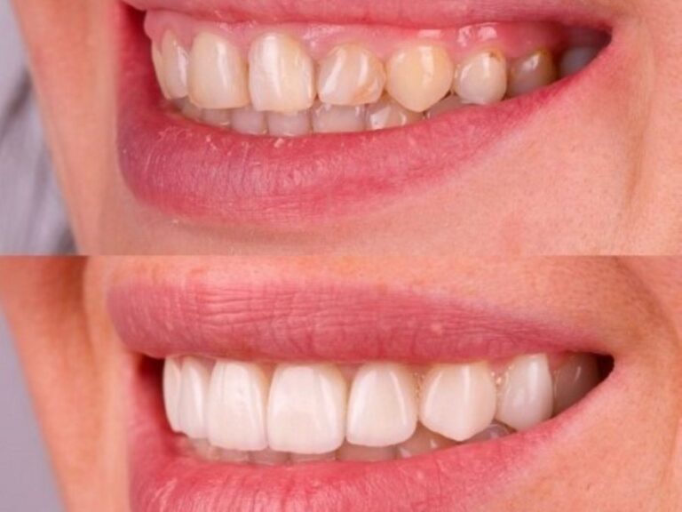 Tổng hợp 70+ hình ảnh răng đẹp, nụ cười đẹp chuẩn nha khoa – Nha Khoa ...