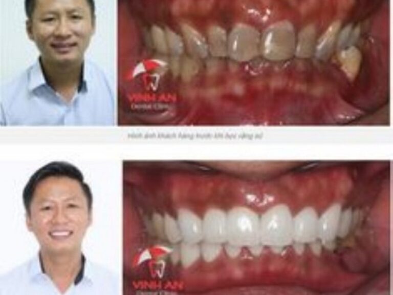 Tổng hợp 70+ hình ảnh răng đẹp, nụ cười đẹp chuẩn nha khoa – Nha Khoa ...