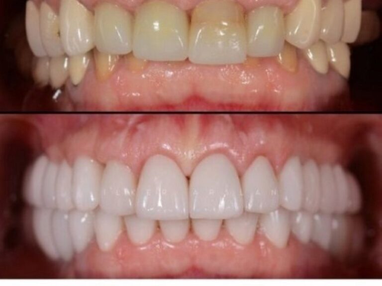 Tổng hợp 70+ hình ảnh răng đẹp, nụ cười đẹp chuẩn nha khoa – Nha Khoa ...