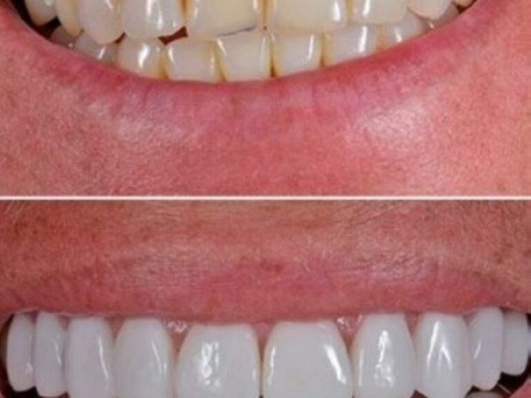 Tổng hợp 70+ hình ảnh răng đẹp, nụ cười đẹp chuẩn nha khoa – Nha Khoa ...