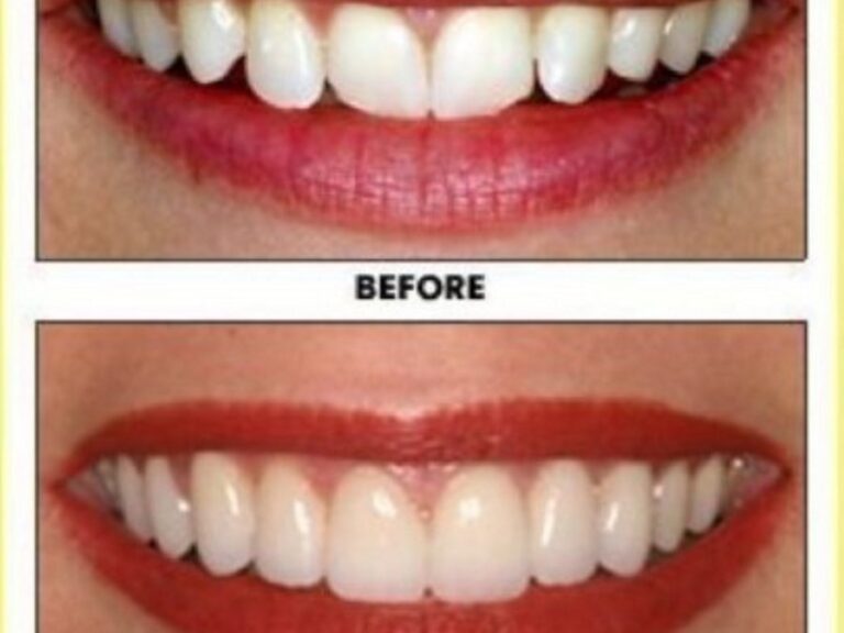 Tổng hợp 70+ hình ảnh răng đẹp, nụ cười đẹp chuẩn nha khoa – Nha Khoa ...