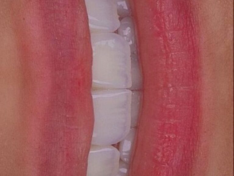 Tổng hợp 70+ hình ảnh răng đẹp, nụ cười đẹp chuẩn nha khoa – Nha Khoa ...