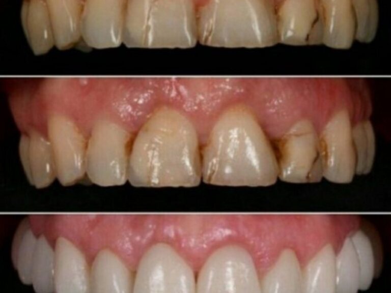 Tổng hợp 70+ hình ảnh răng đẹp, nụ cười đẹp chuẩn nha khoa – Nha Khoa ...