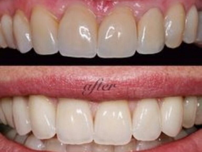 Tổng hợp 70+ hình ảnh răng đẹp, nụ cười đẹp chuẩn nha khoa – Nha Khoa ...