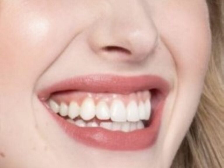 Tổng hợp 70+ hình ảnh răng đẹp, nụ cười đẹp chuẩn nha khoa – Nha Khoa ...