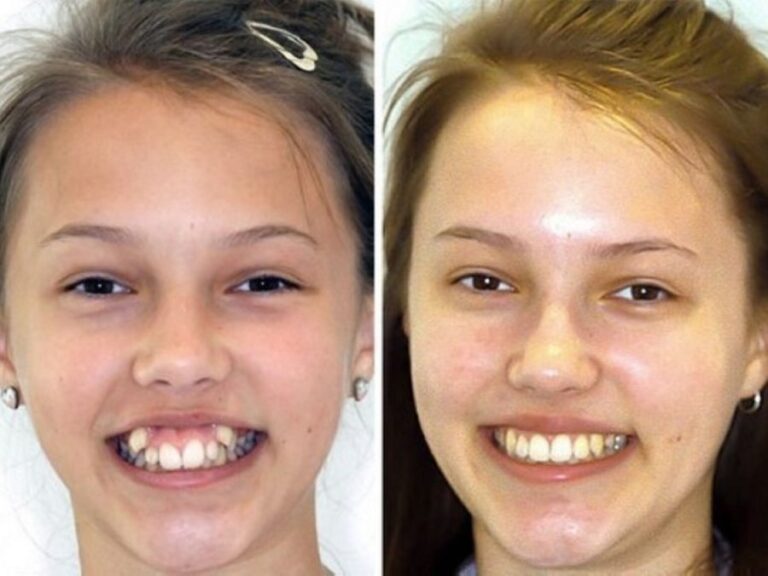 Tổng hợp 70+ hình ảnh răng đẹp, nụ cười đẹp chuẩn nha khoa – Nha Khoa ...