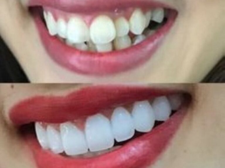 Tổng hợp 70+ hình ảnh răng đẹp, nụ cười đẹp chuẩn nha khoa – Nha Khoa ...