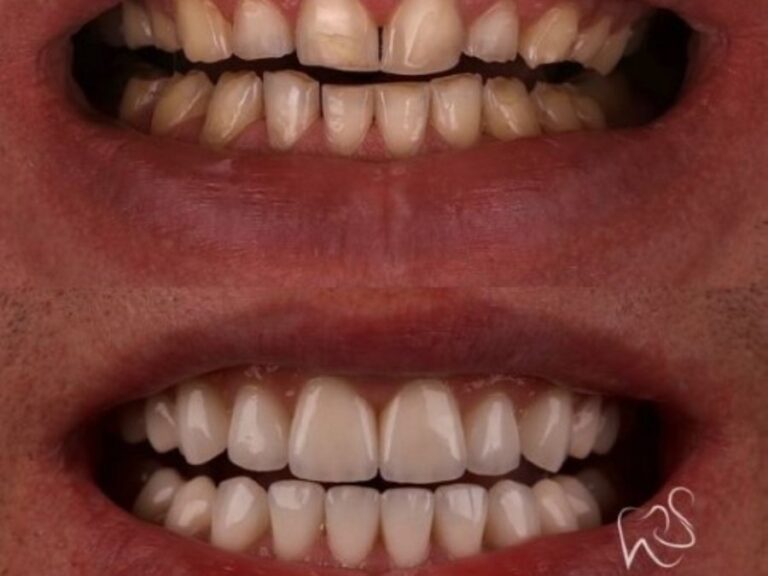 Tổng hợp 70+ hình ảnh răng đẹp, nụ cười đẹp chuẩn nha khoa – Nha Khoa ...