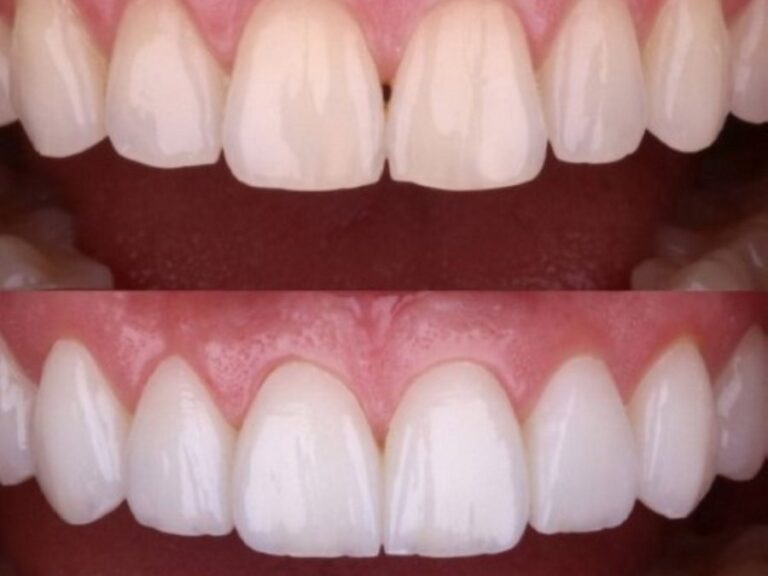 Tổng hợp 70+ hình ảnh răng đẹp, nụ cười đẹp chuẩn nha khoa – Nha Khoa ...