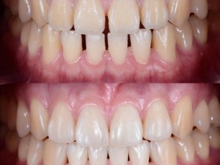 Tổng hợp 70+ hình ảnh răng đẹp, nụ cười đẹp chuẩn nha khoa – Nha Khoa ...