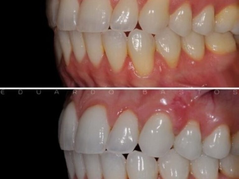 Tổng hợp 70+ hình ảnh răng đẹp, nụ cười đẹp chuẩn nha khoa – Nha Khoa ...