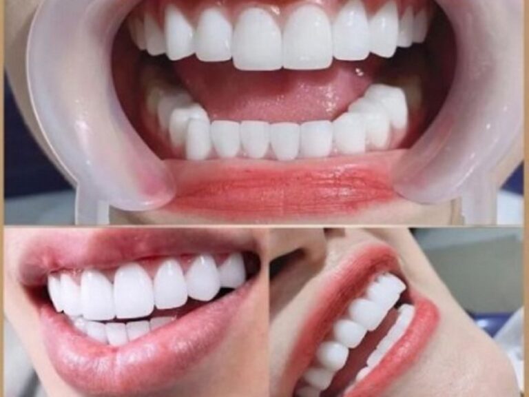 Tổng hợp 70+ hình ảnh răng đẹp, nụ cười đẹp chuẩn nha khoa – Nha Khoa ...