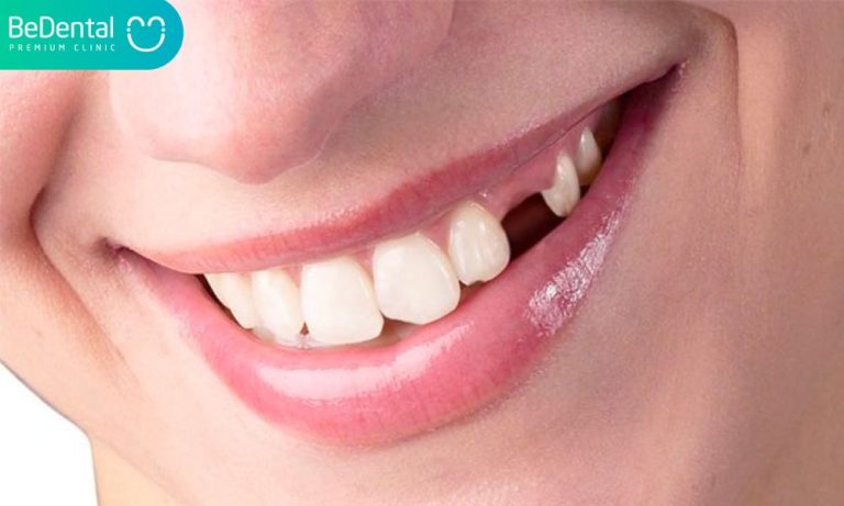 Which tooth is number 4 tooth? The consequences of losing it – Nha Khoa ...