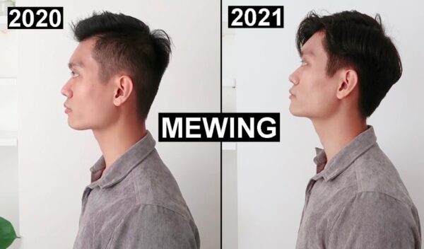 Mewing là gì? – Nha Khoa BeDental