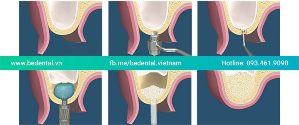 Maxillary sinus augmentation – Nha Khoa BeDental
