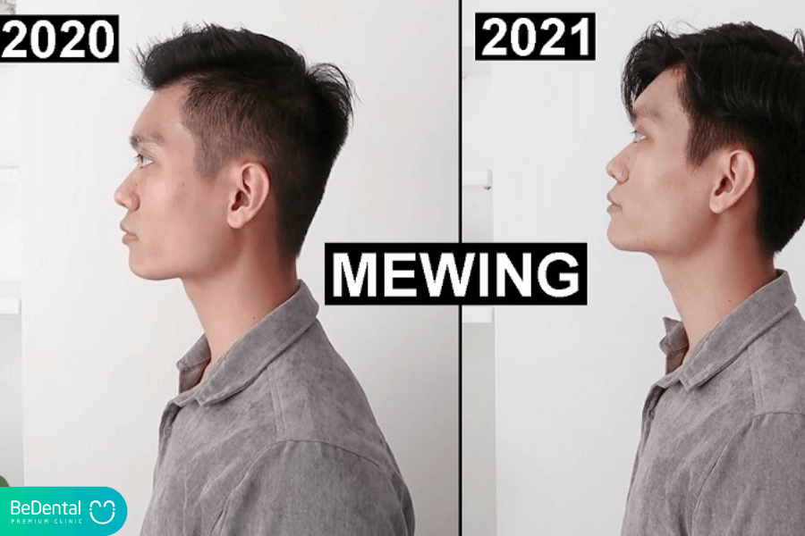 Phương pháp mewing là gì? 1 số lưu ý với những người mới – Nha Khoa ...