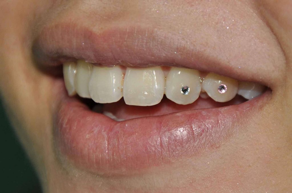 7 Good types of tooth stones – Beautiful and safe tooth stones at ...