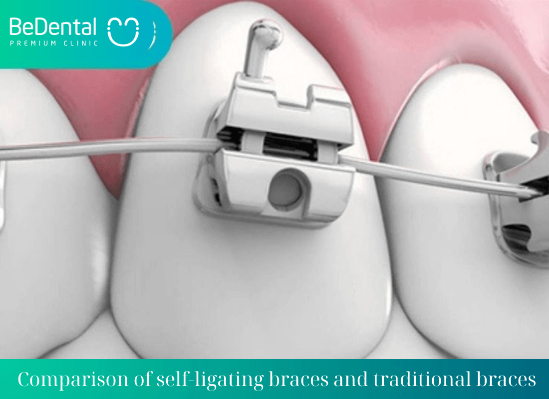 Braces with self-ligating metal brackets – Nha Khoa BeDental