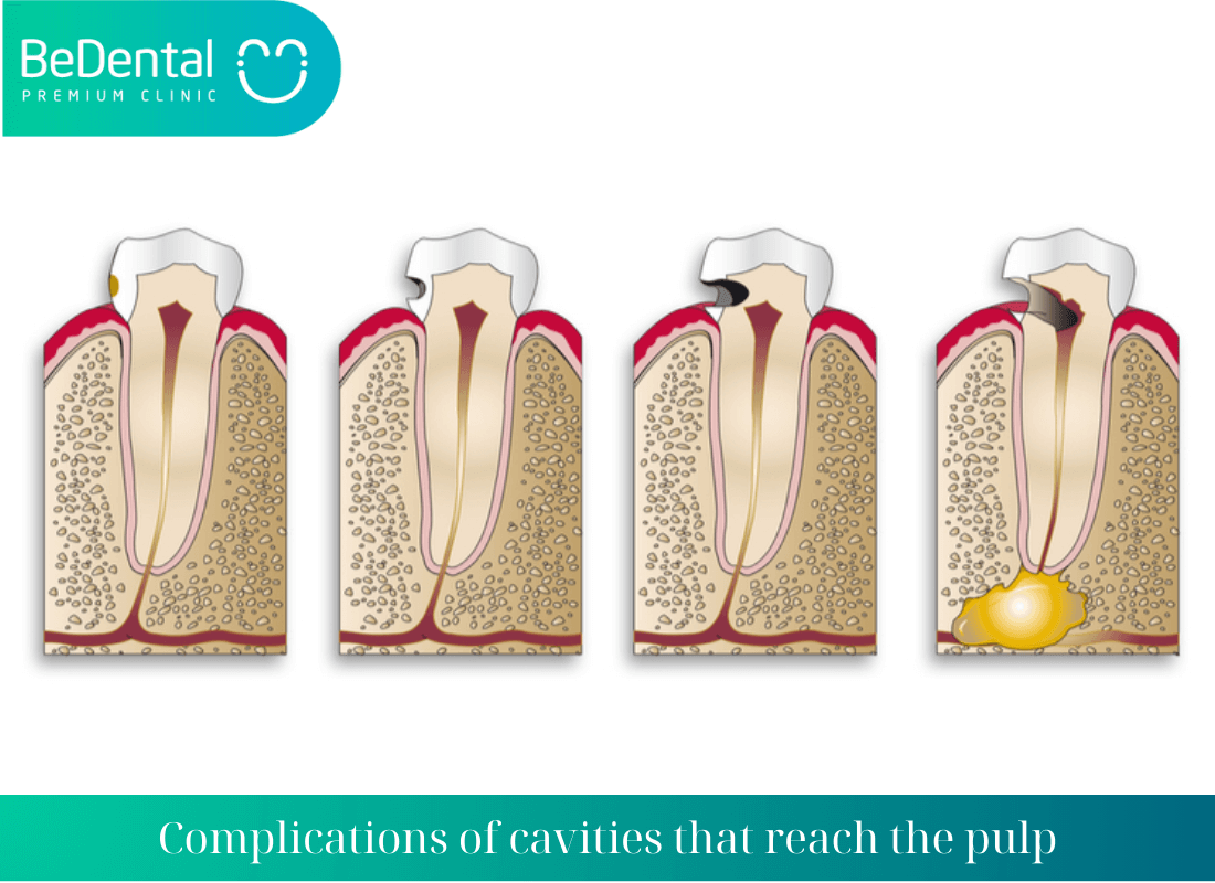 Tooth cavities that reach the pulp – Some complications and timely treatment – Nha Khoa BeDental