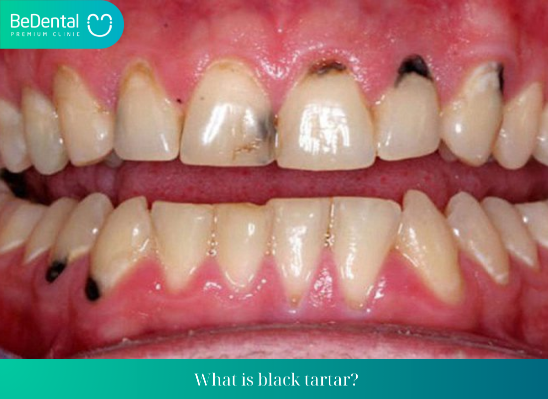 What to do with Black Tartar? 4 Causes and Treatment – Nha Khoa BeDental