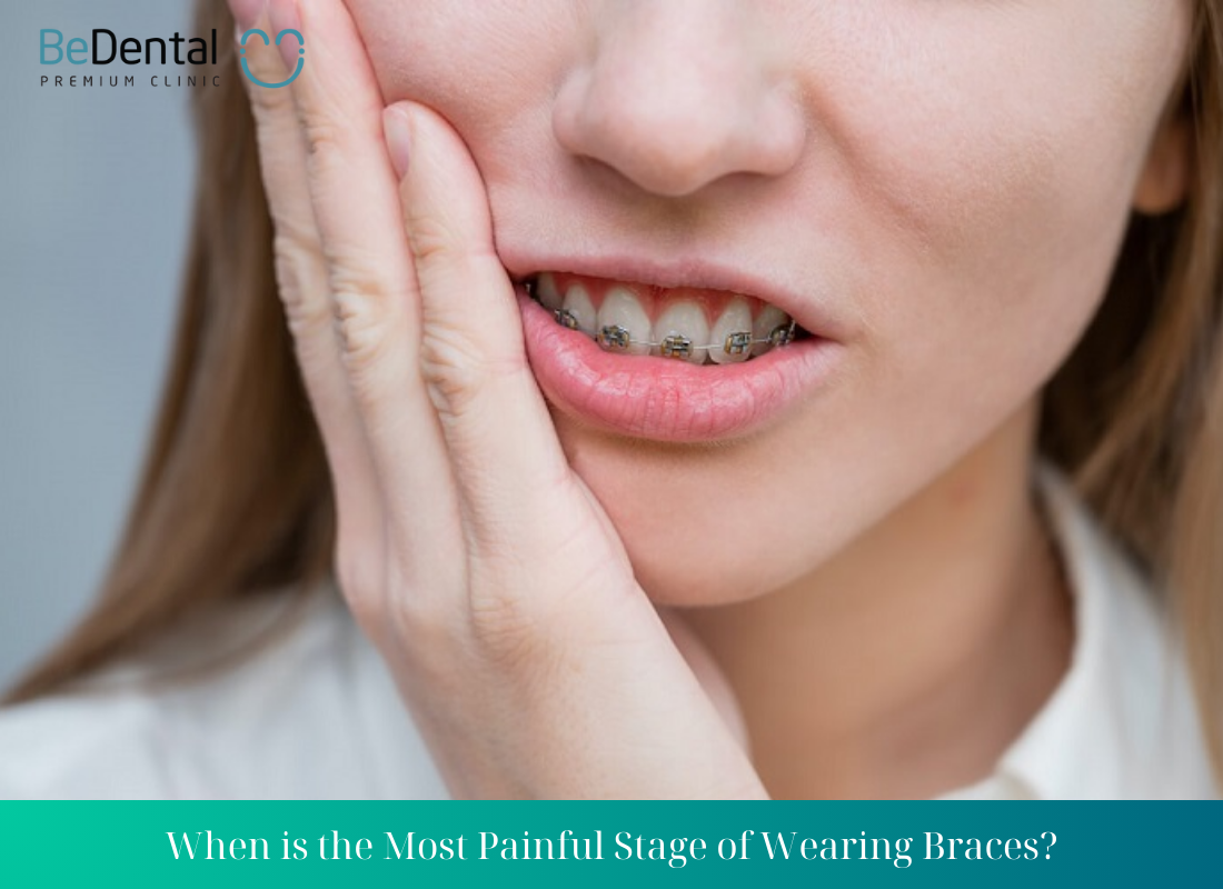 Stages of wearing braces that you should know – Nha Khoa BeDental