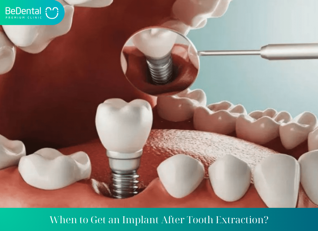 When To Get An Implant After Tooth Extraction? – Nha Khoa BeDental