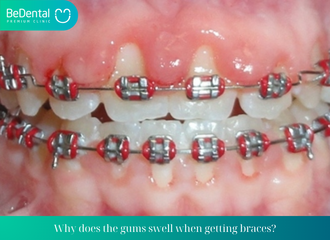 Why does the gums swell when getting braces? – Nha Khoa BeDental