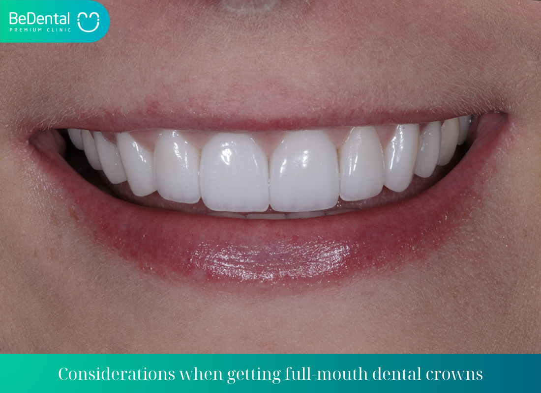 The price of full-mouth dental crowns at BeDental – Nha Khoa BeDental