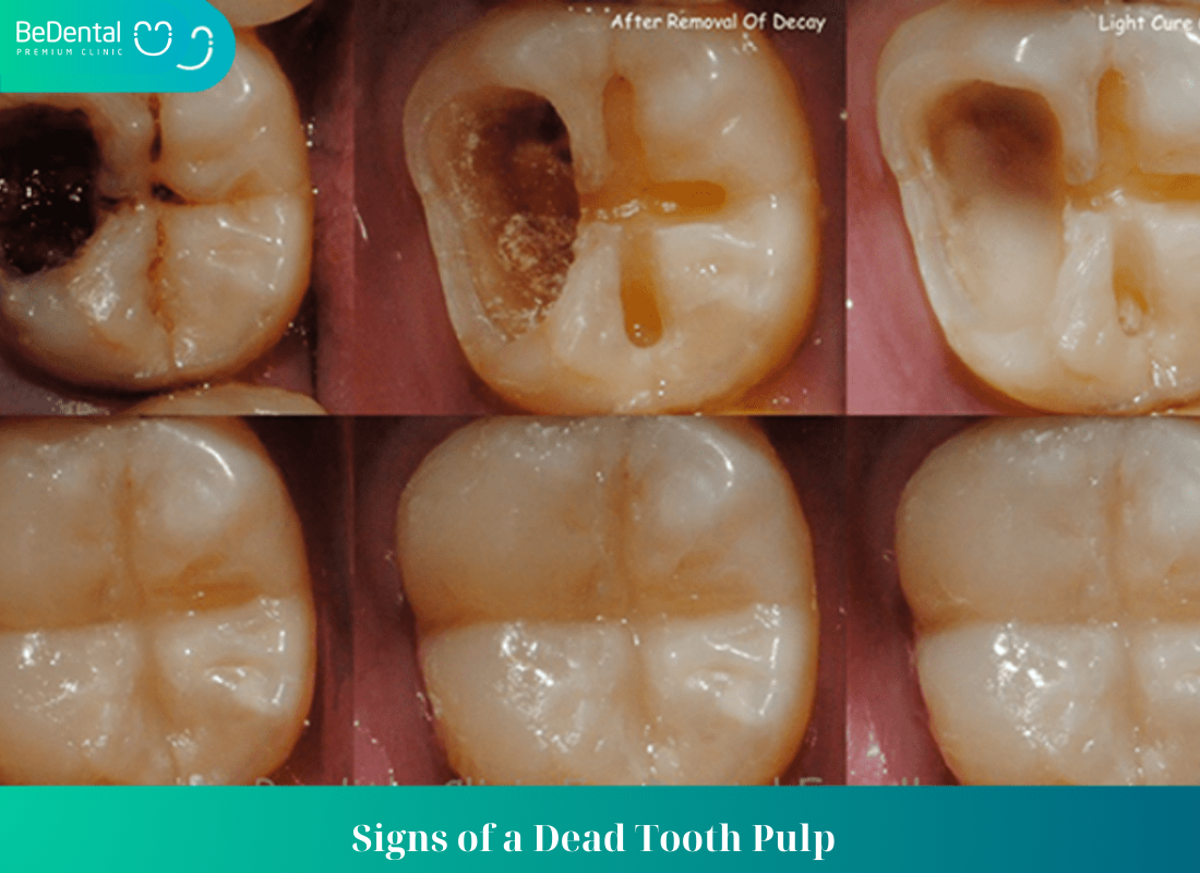 Dead Tooth Pulp and Everything You Need to Know – Nha Khoa BeDental