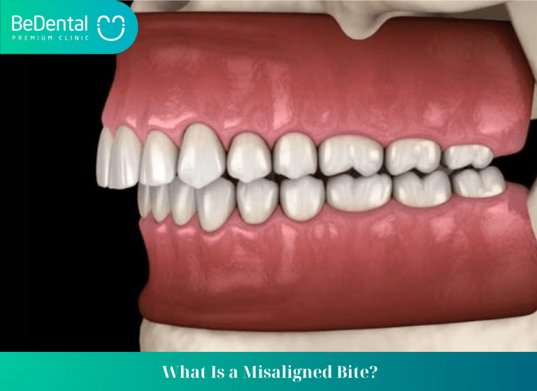 What is a Misaligned Bite ? How Does It Affect the Face? – Nha Khoa BeDental