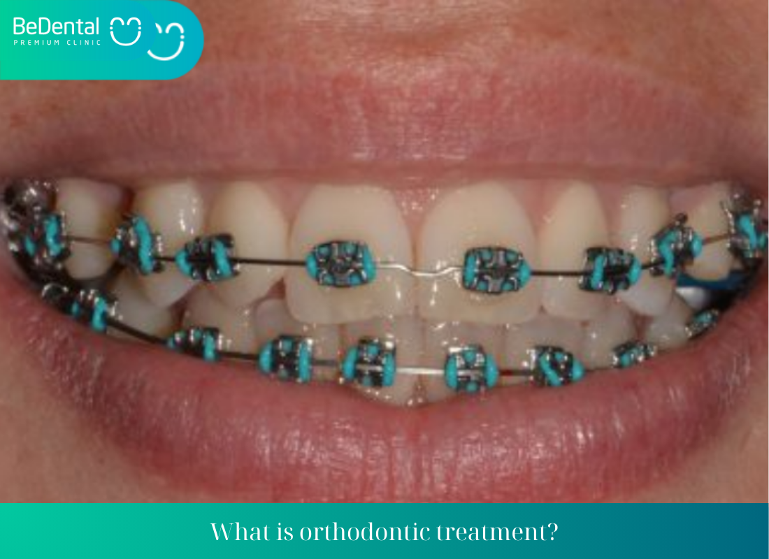 What is orthodontic treatment? Should you get braces? – Nha Khoa BeDental