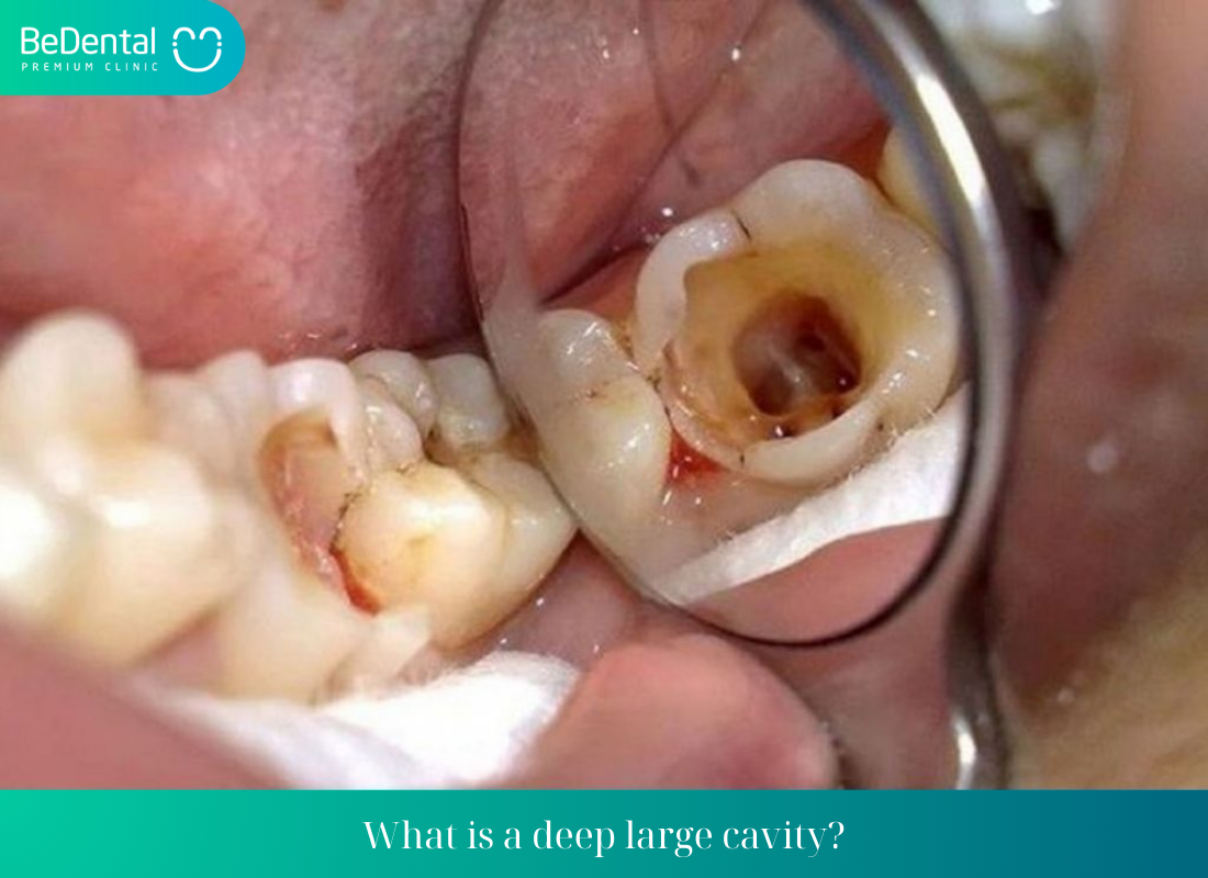 How much does it cost to fill a large cavity? – Nha Khoa BeDental