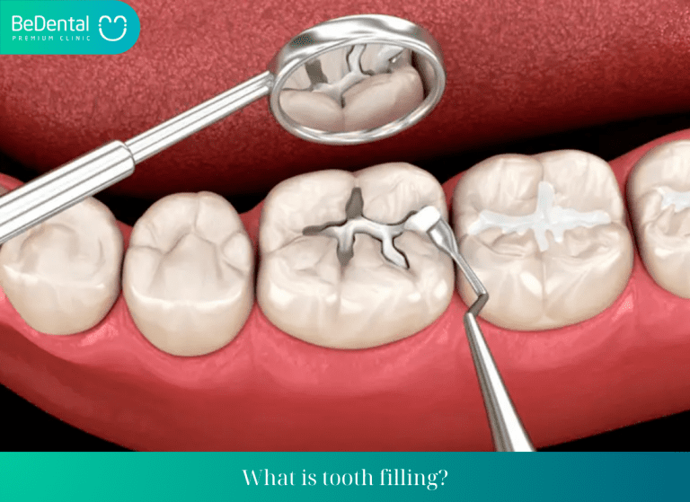 What is tooth filling? Common types of tooth filling materials used ...